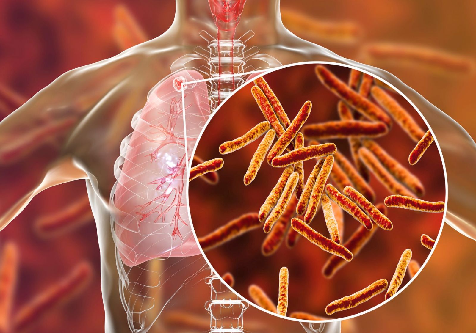 Verem (Tüberküloz) Nedir? Belirtileri, Nedenleri ve Teşhis Yöntemleri