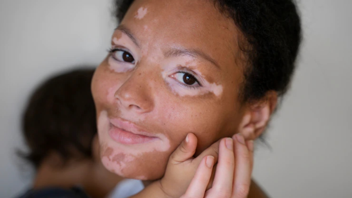 Vitiligo Nedir? Belirtileri ve Tedavi Yöntemleri